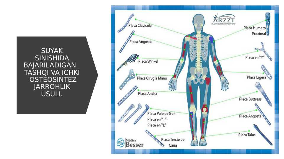 SUYAK SINISHIDA BAJARILADIGAN TASHQI VA ICHKI OSTEOSINTEZ JARROHLIK USULI